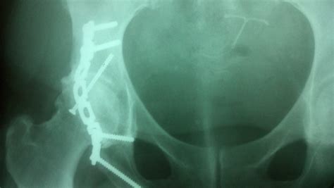 Posterior Acetabular Wall Fractures Wheeless Textbook Of Orthopaedics