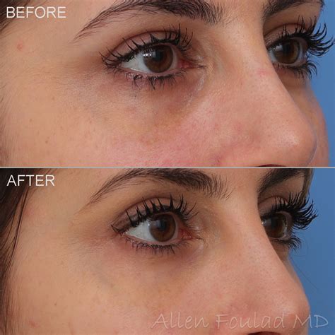 Cosmetic Dermal Fillers In Beverly Hills Allen Foulad Md