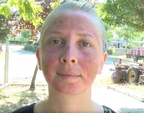 Chemical Burn On Face Treatment Mumuworks