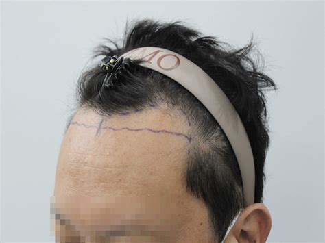 부산리즈모 부산리즈모의원에서 수술받은 모발이식 8개월 후기입니다 모발이식 후기리뷰비용은 대다모