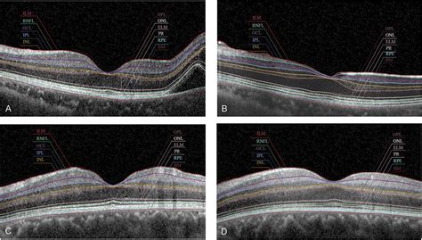 Retinal Layer Segmentation After Silicone Oil Or Gas Tampona Retina