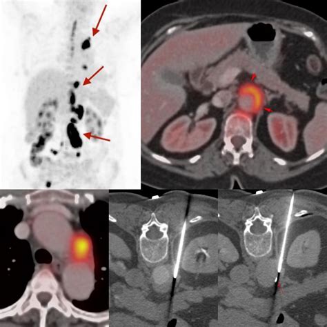 Peri Aortitis Biopsy These Are Not Really Difficult Ref India