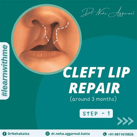All Cleft Jeevan Jyoti Hospital And Research Centre