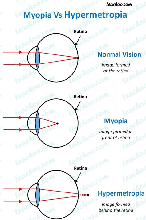 Hyperopia Vs Myopia Key Differences Hyperopia Farsightedness … Mazhar Qayyum