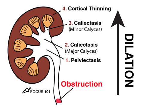 Tired Of Irradiating Your Patients With Ct Scans🙋‍♀️ Learn Renal Ultrasound Pocus 1⃣perform