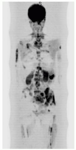 Diffuse Marrow Diseases Musculoskeletal Key