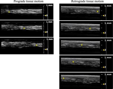 Consecutive Frames Of Tracked Motion Of An Individual Tissue Feature In