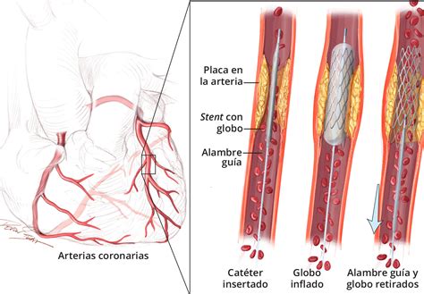 Situaciones Que Requieren La Colocación De Un Stent 👌 Christiangallegos