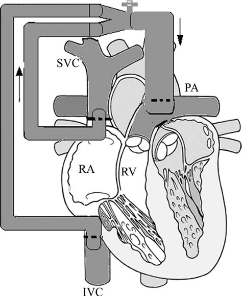 Temporary Total Cavopulmonary Connection T Tcpc System The Superior