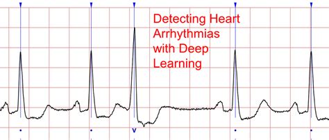 detecting heart arrhythmias with deep learning in keras with dense cnn