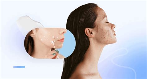 Doxycycline Hyclate Vs Monohydrate For Treating Acne