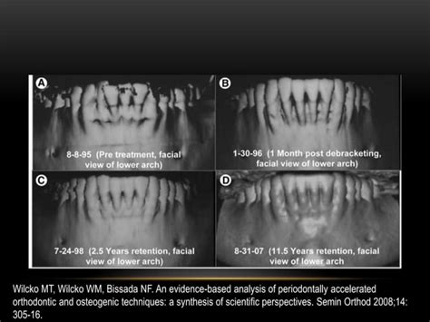 Corticotomy For Rapid Acceleration Pptx Dental Health Diseases