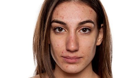 Bad Acne Skin