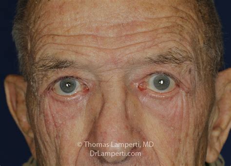 Blepharoplasty Eyelid Surgery Seattle Facial Plastic Surgeon Dr Lamperti Seattle Wa
