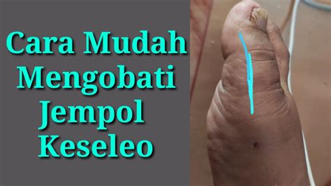 Cara Cepat Mengobati Keseleo Jempol Kaki Gampang Efektif Manjur