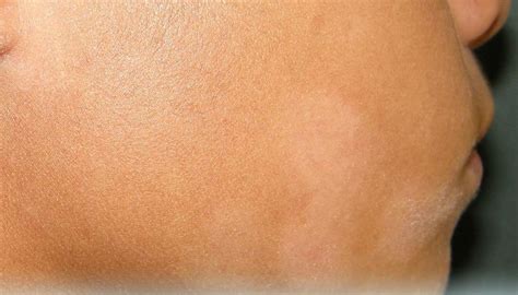 Panu Bikin Nggak Pede 7 Cara Menghilangkan Panu Di Wajah Yang Membandel Dengan Mudah