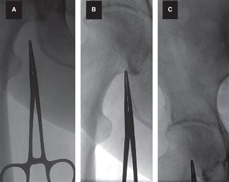Access Complications Clinical Tree