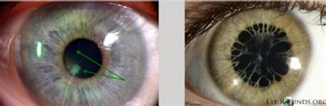 Lecture 10 Anterior Uvea Flashcards Quizlet