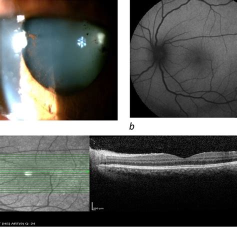 Slit Photo Of The Left Eye Shows Diffuse Kps Posterior Synechia Download Scientific Diagram