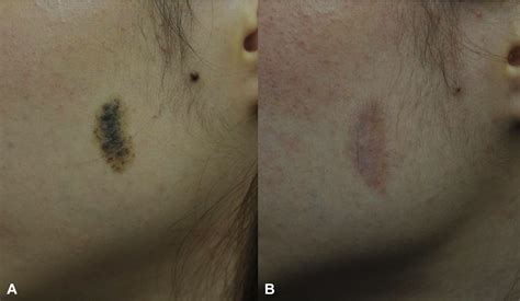 Long Term Outcomes Of Laser Treatment For Congenital Melanocytic Nevi
