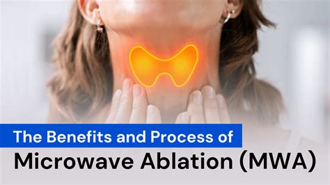 Save Your Thyroid Exploring Microwave Ablation For Thyroid Nodules