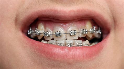 Southeast Asian Teenagers Are Obsessed With Fake Fashion Braces