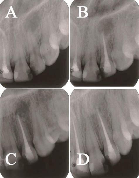 A Initial Radiograph Revealed Large Periapical Lesion B Radiograph Download Scientific