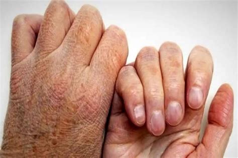 پشت پرده شیوع بیماری جذام در ایران وزارت بهداشت توضیح داد