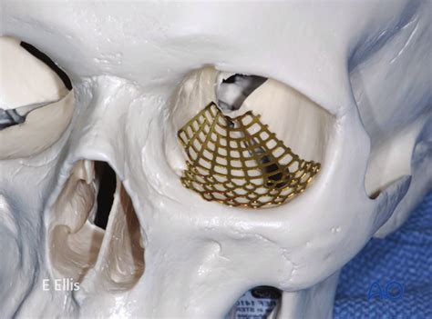 Reconstruction Of Orbital Floorwall Defects For Orbital Wall Defects