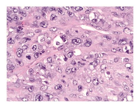 Large Cells With Pleomorphic Nuclei Some With Folded Nuclear Contours