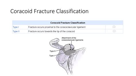 Upper Extremity Shoulder Fracture Pptx