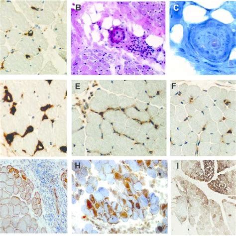 Capillary Involvement In Dermatomyositis Dm A The Point Pattern Download Scientific