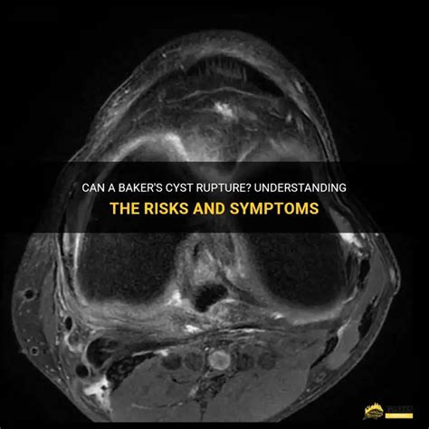 Can A Bakers Cyst Rupture Understanding The Risks And Symptoms