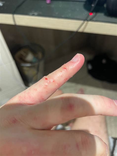 Scabies Reinfection 3 Weeks Post Treatment Rscabies