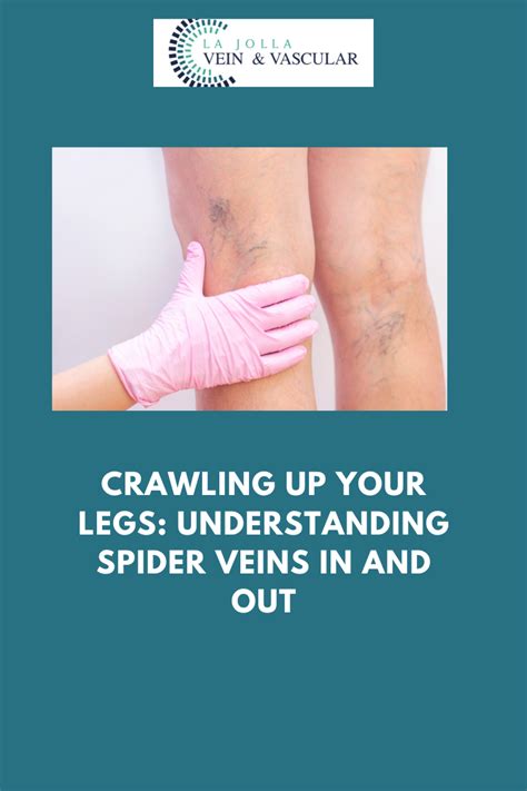 Crawling Up Your Legs Understanding Spider Veins In And Out