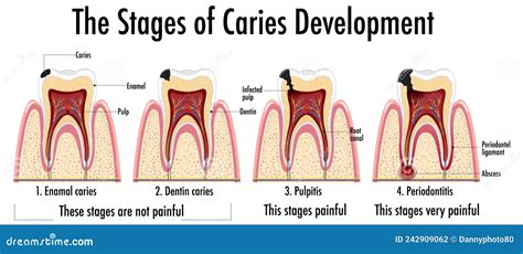 The Stages Of Caries Development Vector Illustration