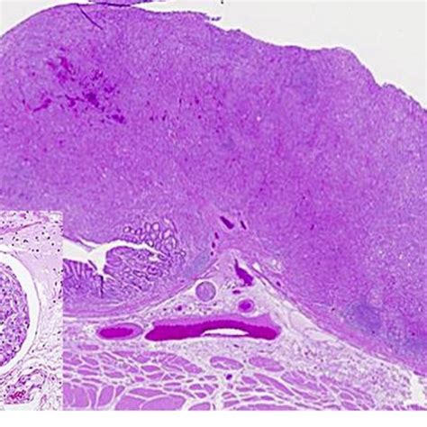 Case 1 Showed A Polypoid Solid Intramucosal Lesion Submucosal