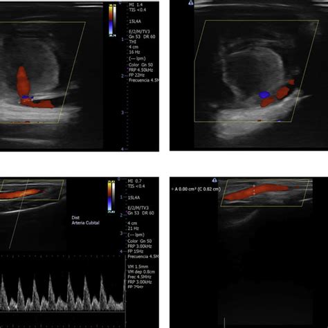 A Pseudoaneurysm On Anterior Wall Of Radial Artery An Almost 40 Mm