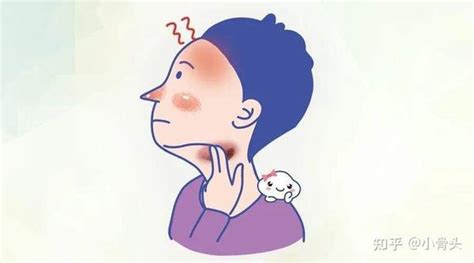 颌骨骨髓炎的类型 知乎