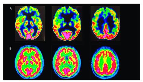 A Brain 18 Fdg Pet Of The Mother Showing Severe Hypometabolism In