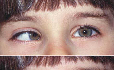 A Su Salud El Estrabismo