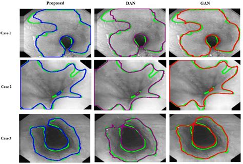 Visual Samples Of The Segmentation Performance Of Semi Supervised Download Scientific Diagram