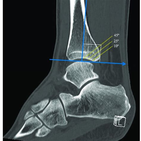 The Angle Between The Fracture Line And The Z Axis On The Sagittal Download Scientific Diagram