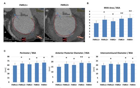 Dimensions Of Mitral Valve Annulus Dimensions In Patients With Or Download Scientific Diagram