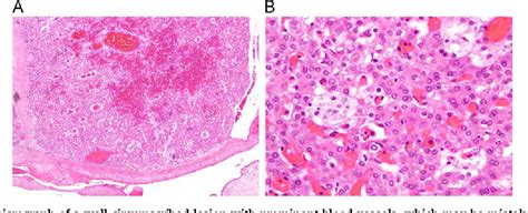 Figure 2 From Pseudotumors Of The Placenta Semantic Scholar