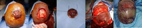 Tumour At Vertex Post Wide Excision Defect Closed With Rotation Flap