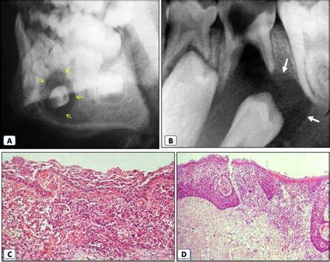 Case 2 A Lateral Cephalogram Showing Unilocular Pericoronal