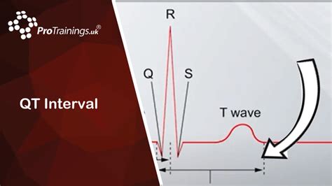 Qt Interval Ecg Awareness Online Training Video Ecg Awareness Level 3 Vtq