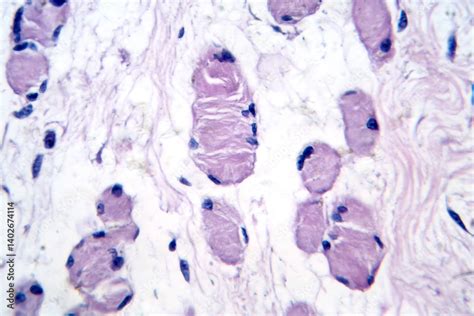 Skeletal Muscle Atrophy Photomicrograph Showing Decreased Fiber Size With Increased Spacing