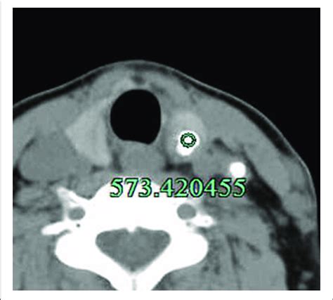 Method For Measuring The Ct Value Of The Calcified S In Nodule The